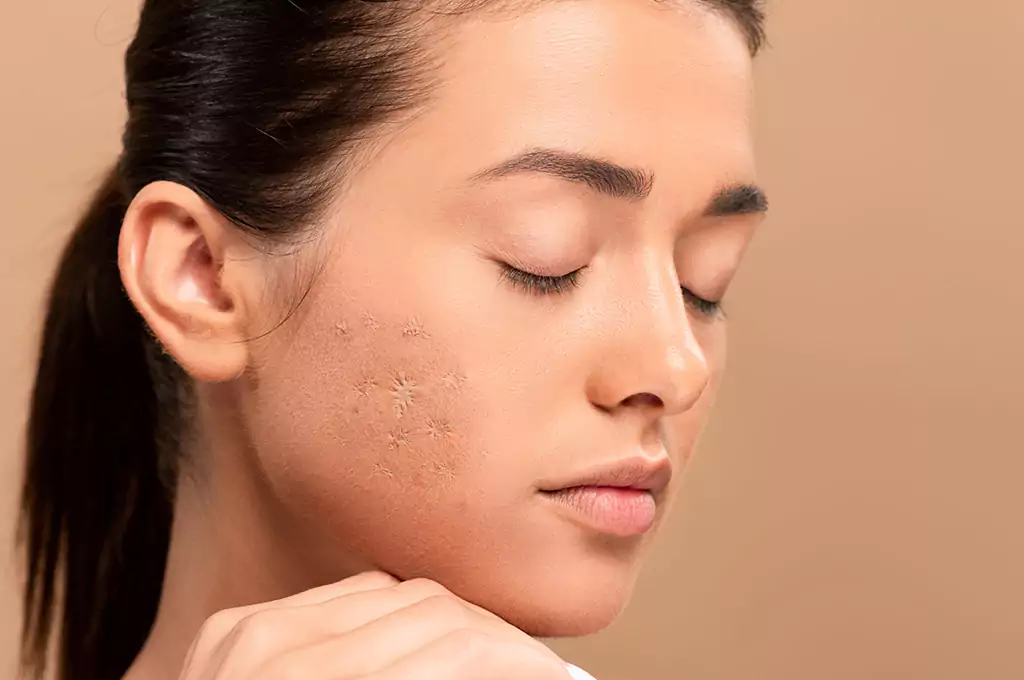 The Ultimate Guide to Facial Scars: Types, Causes, and Treatment ...